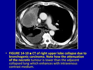 Pulmonary Lobar Collapse: Essential Considerations 14 Dr. Muhammad Bin ...