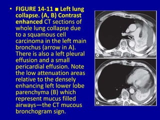 Pulmonary Lobar Collapse: Essential Considerations 14 Dr. Muhammad Bin ...