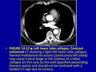 Pulmonary Lobar Collapse: Essential Considerations 14 Dr. Muhammad Bin ...