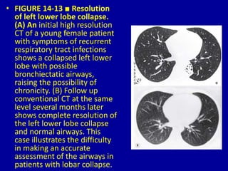 Pulmonary Lobar Collapse: Essential Considerations 14 Dr. Muhammad Bin ...