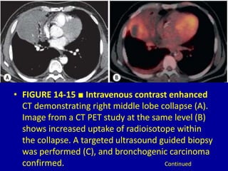 Pulmonary Lobar Collapse: Essential Considerations 14 Dr. Muhammad Bin ...