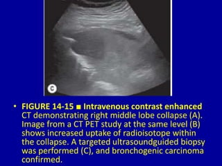 Pulmonary Lobar Collapse: Essential Considerations 14 Dr. Muhammad Bin ...