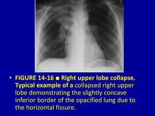 Pulmonary Lobar Collapse: Essential Considerations 14 Dr. Muhammad Bin ...