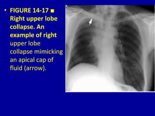 Pulmonary Lobar Collapse: Essential Considerations 14 Dr. Muhammad Bin ...