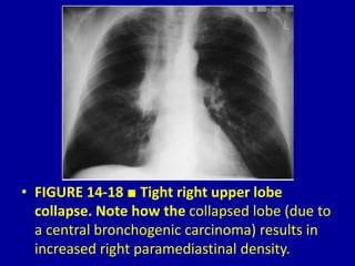 Pulmonary Lobar Collapse: Essential Considerations 14 Dr. Muhammad Bin ...
