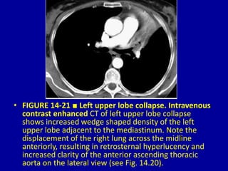 Pulmonary Lobar Collapse: Essential Considerations 14 Dr. Muhammad Bin ...