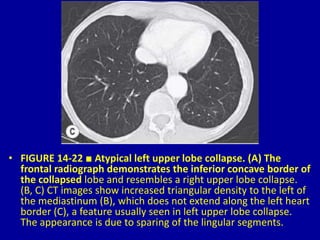 Pulmonary Lobar Collapse: Essential Considerations 14 Dr. Muhammad Bin ...