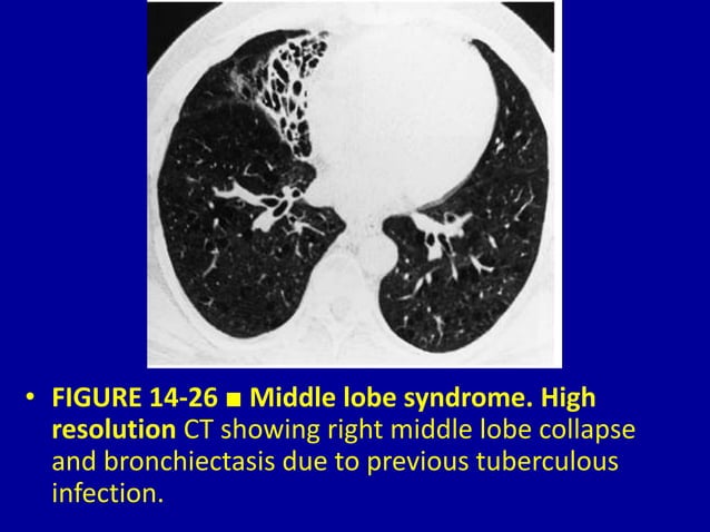 Pulmonary Lobar Collapse: Essential Considerations 14 Dr. Muhammad Bin ...