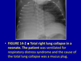 Pulmonary Lobar Collapse: Essential Considerations 14 Dr. Muhammad Bin ...