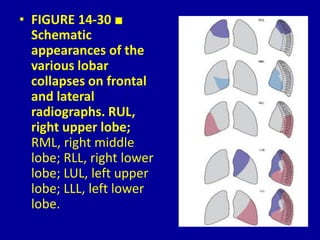 Pulmonary Lobar Collapse: Essential Considerations 14 Dr. Muhammad Bin ...