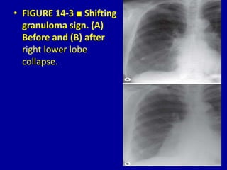 Pulmonary Lobar Collapse: Essential Considerations 14 Dr. Muhammad Bin ...