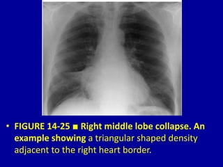 Right Middle Lobe Collapse X Ray