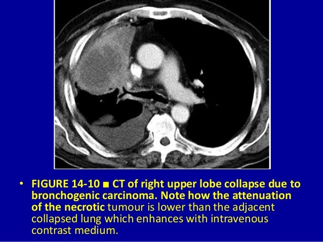 Pulmonary Lobar Collapse:vEssential Considerations 14 Dr. Muhammad Bi…