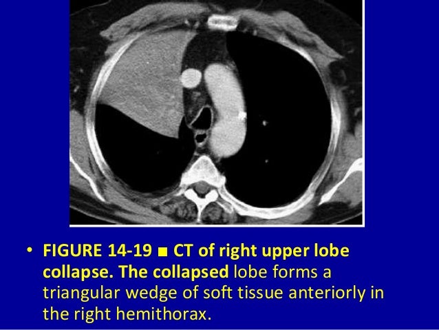 Pulmonary Lobar Collapse:vEssential Considerations 14 Dr. Muhammad Bi…