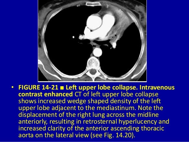 Pulmonary Lobar Collapse:vEssential Considerations 14 Dr. Muhammad Bi…