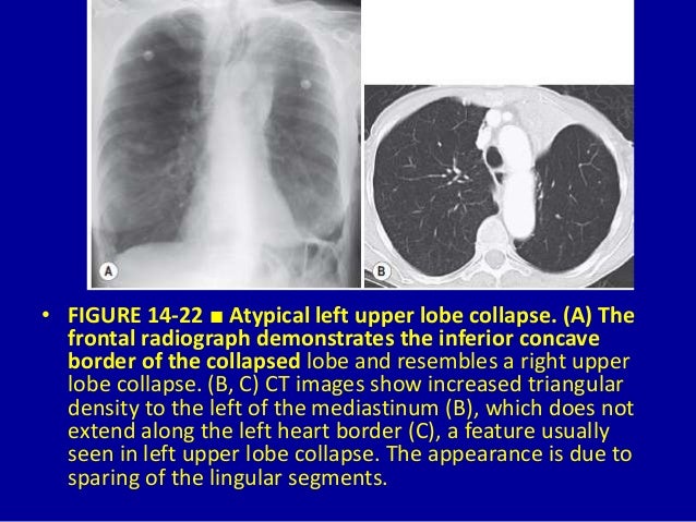 Pulmonary Lobar Collapse:vEssential Considerations 14 Dr. Muhammad Bi…