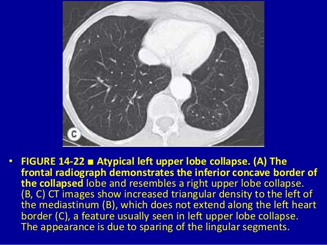 Pulmonary Lobar Collapse:vEssential Considerations 14 Dr. Muhammad Bi…