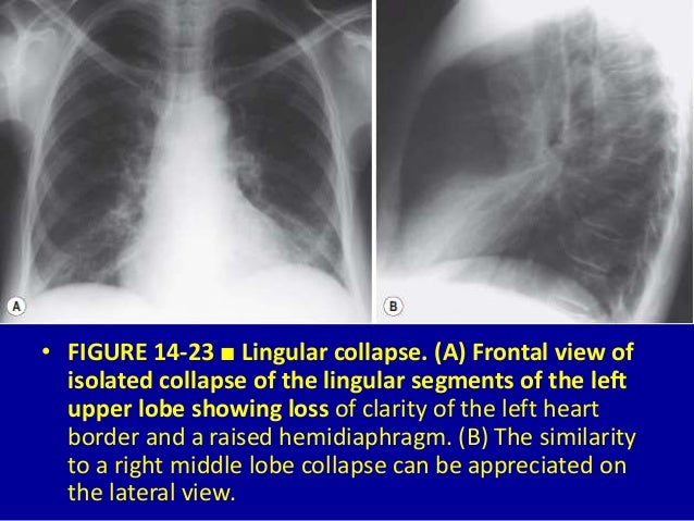 Pulmonary Lobar Collapse:vEssential Considerations 14 Dr. Muhammad Bi…