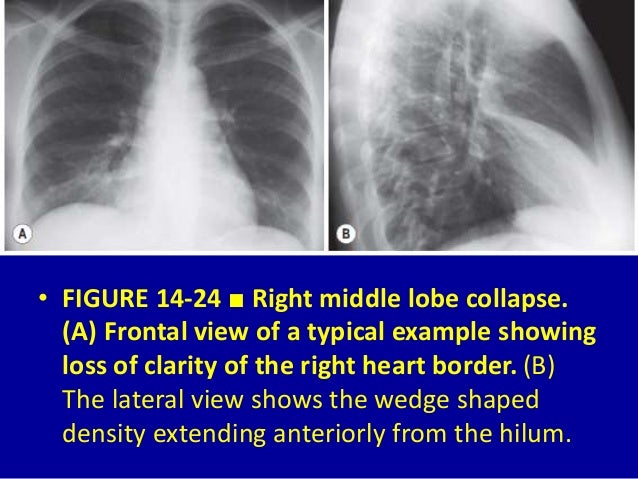 Pulmonary Lobar Collapse:vEssential Considerations 14 Dr. Muhammad Bi…