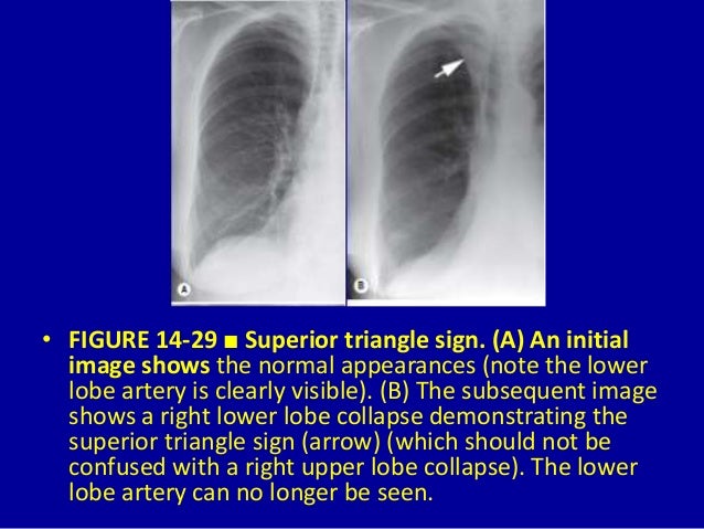 Pulmonary Lobar Collapse:vEssential Considerations 14 Dr. Muhammad Bi…