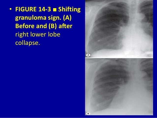 Pulmonary Lobar Collapse:vEssential Considerations 14 Dr. Muhammad Bi…