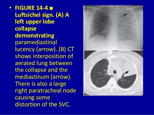 Pulmonary Lobar Collapse:vEssential Considerations 14 Dr. Muhammad Bi…