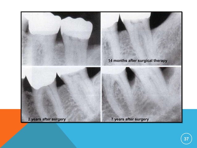 Supportive periodontal therapy , SPT | PPT | Physical Therapy | Wellness