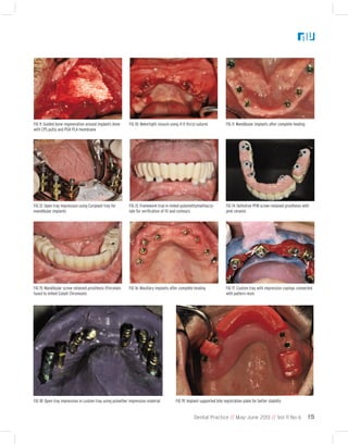 Full mouth rehabilitation with implant supported restorations | PDF