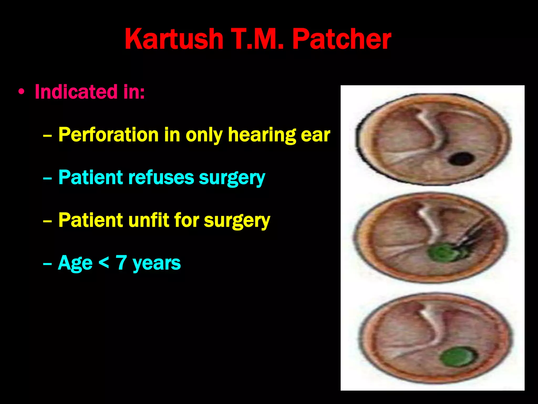 Chronic Suppurative Otitis Media: Tubotympanic Type (CSOM TT) | PPTX
