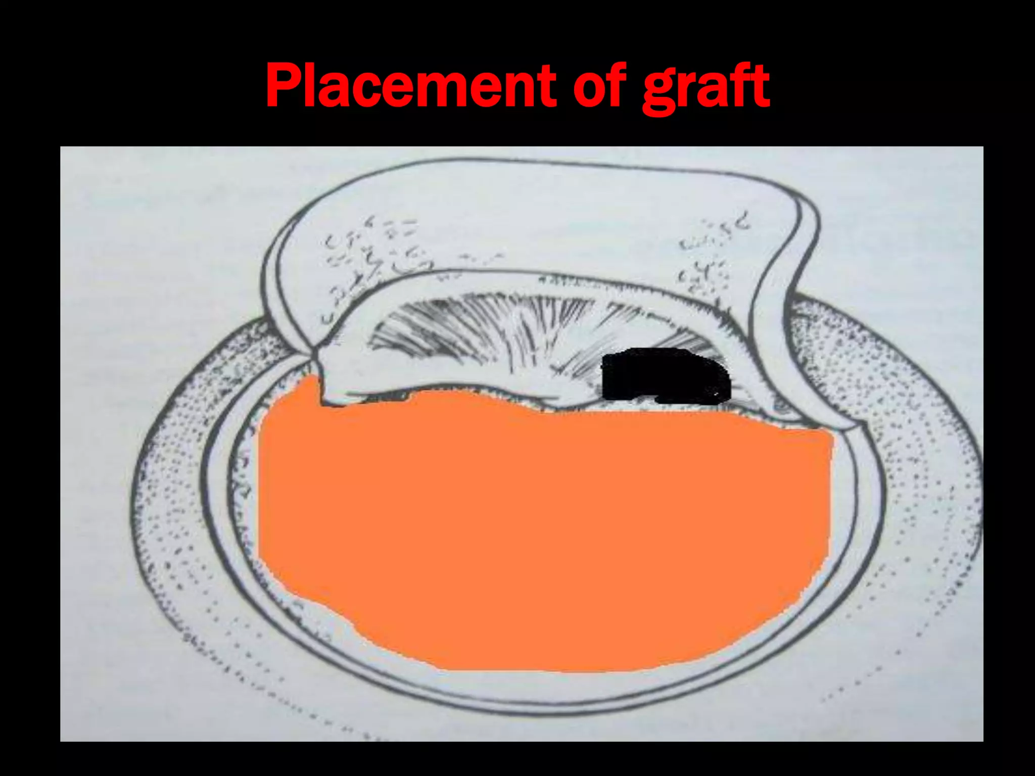 Chronic Suppurative Otitis Media: Tubotympanic Type (CSOM TT) | PPTX