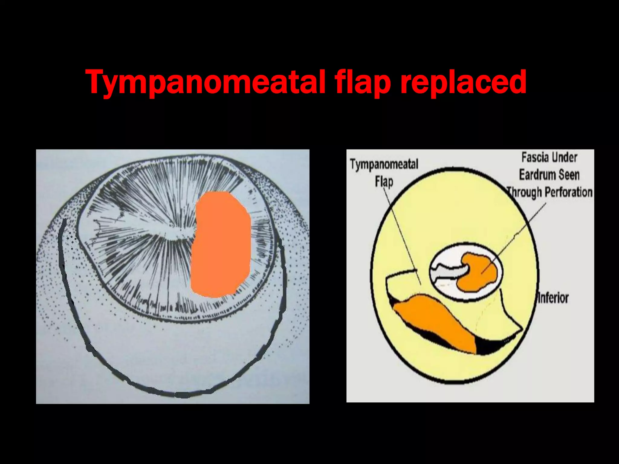 Chronic Suppurative Otitis Media: Tubotympanic Type (CSOM TT) | PPTX