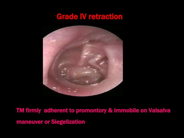 Chronic Suppurative Otitis Media: Tubotympanic Type (CSOM TT) | PPTX