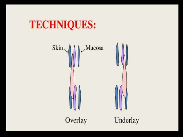 Chronic Suppurative Otitis Media: Tubotympanic Type (CSOM TT) | PPTX
