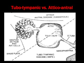 Chronic Suppurative Otitis Media Tubotympanic Type