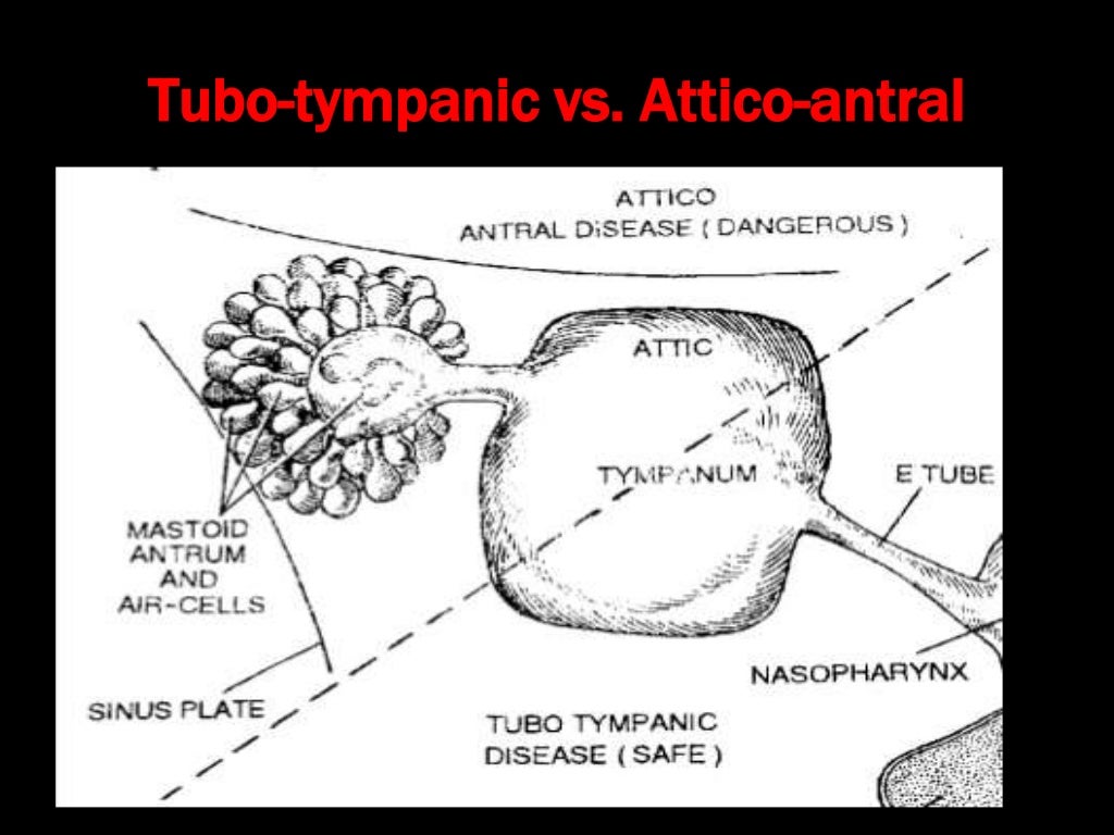 Chronic Suppurative Otitis Media: Tubotympanic Type (CSOM TT)