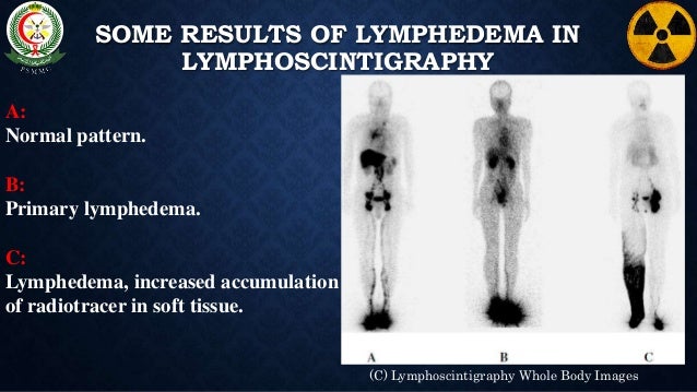 Nuclear Medicine - Lymphoscintigraphy - Case Study
