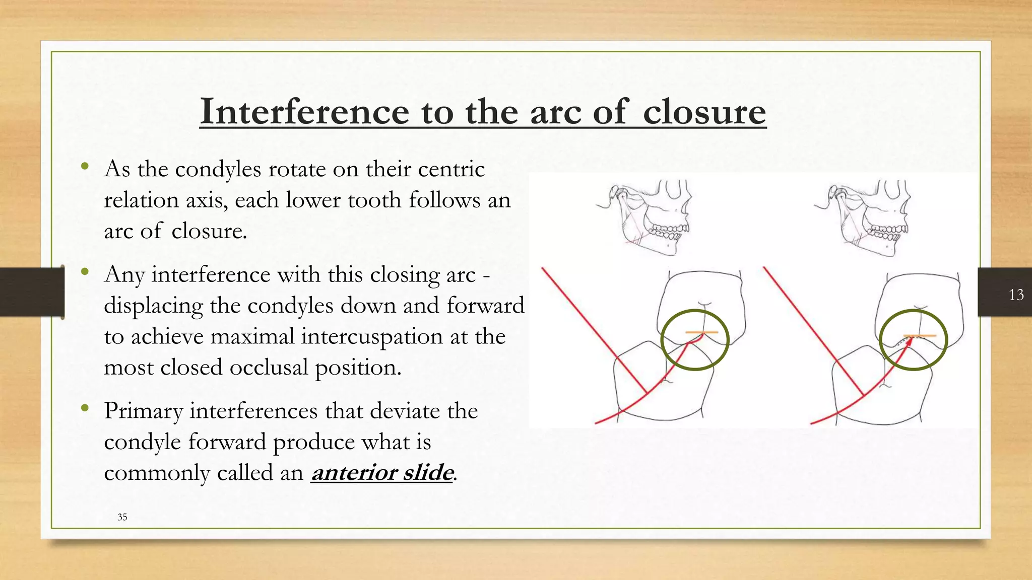 Occlusal equilibration - Kelly | PPTX