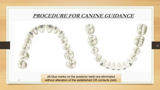 Occlusal equilibration - Kelly | PPTX