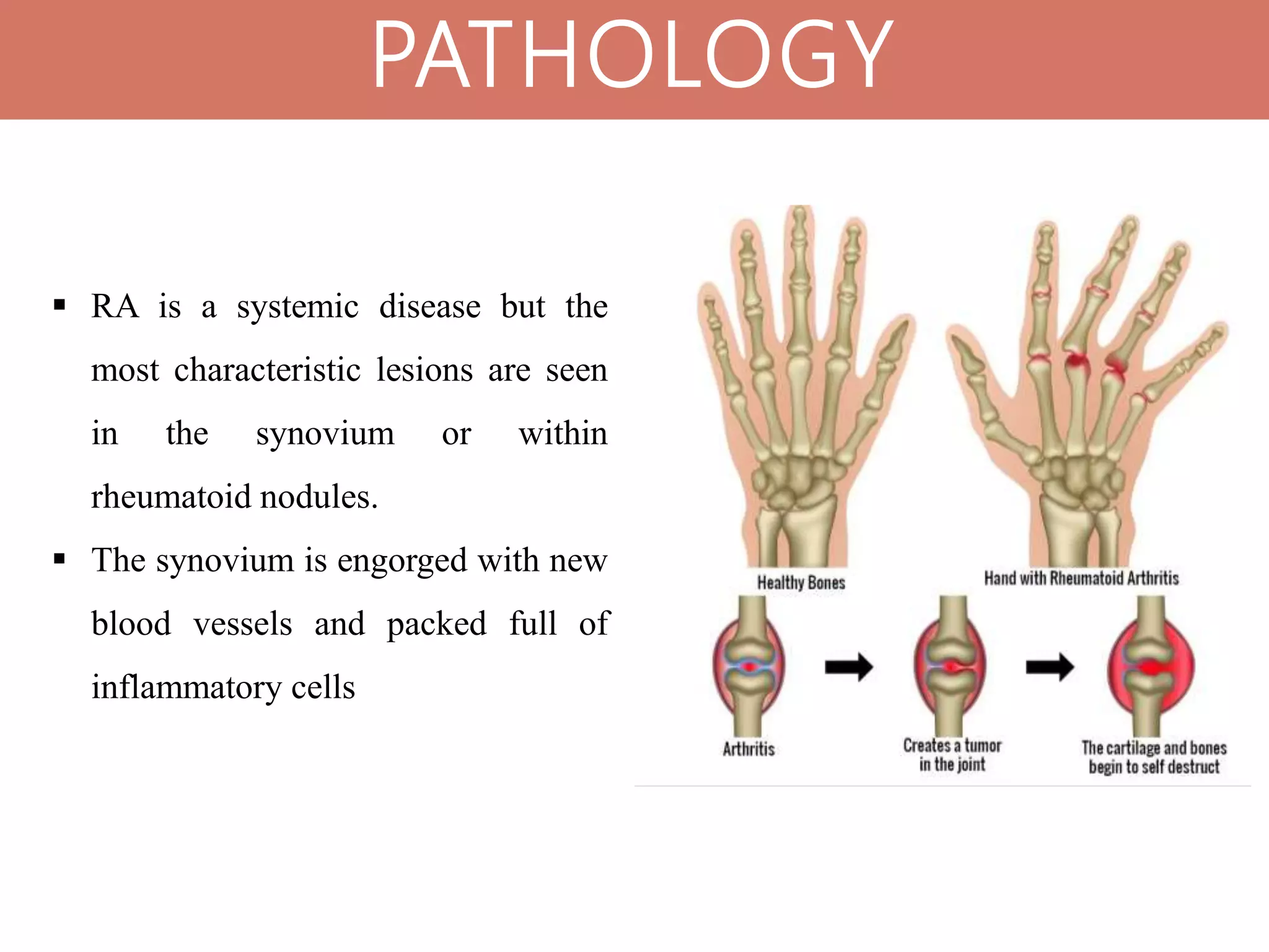 Rheumatoid Arthritis | PPTX
