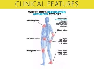 Rheumatoid Arthritis | PPTX