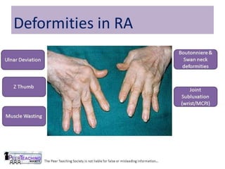 Rheumatoid Arthritis | PPTX
