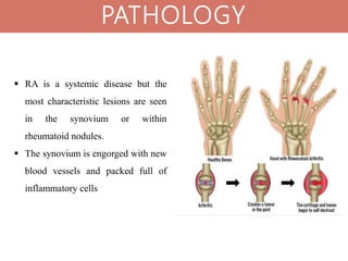 Rheumatoid Arthritis | PPTX