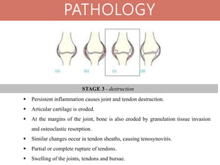 Rheumatoid Arthritis Pathophysiology