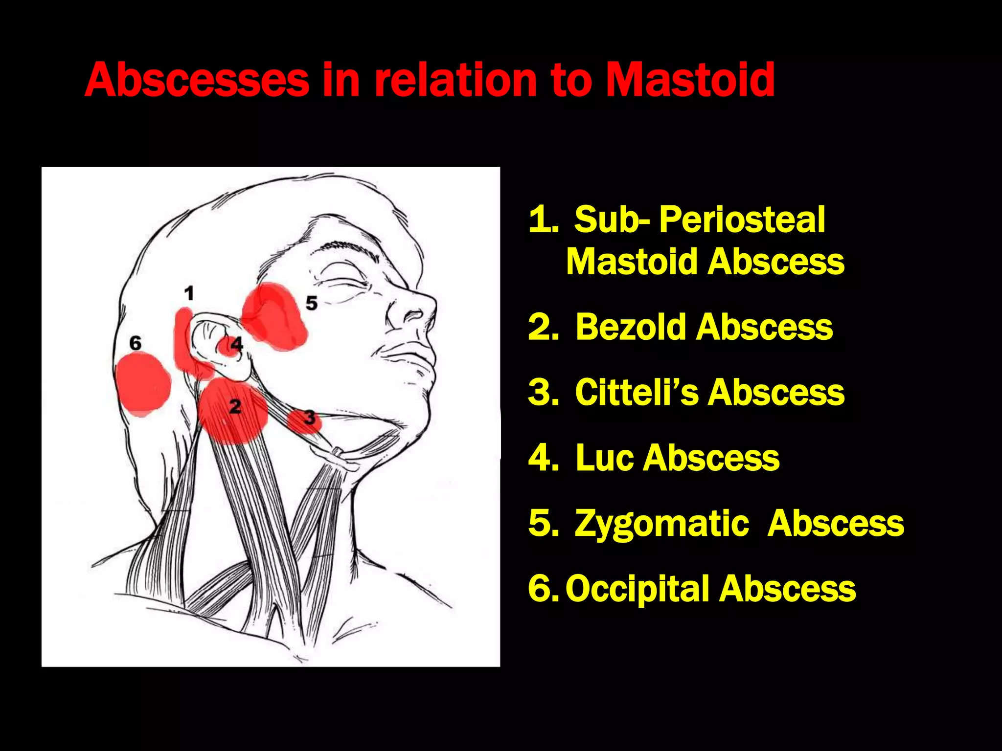 Complications of csom | PPT