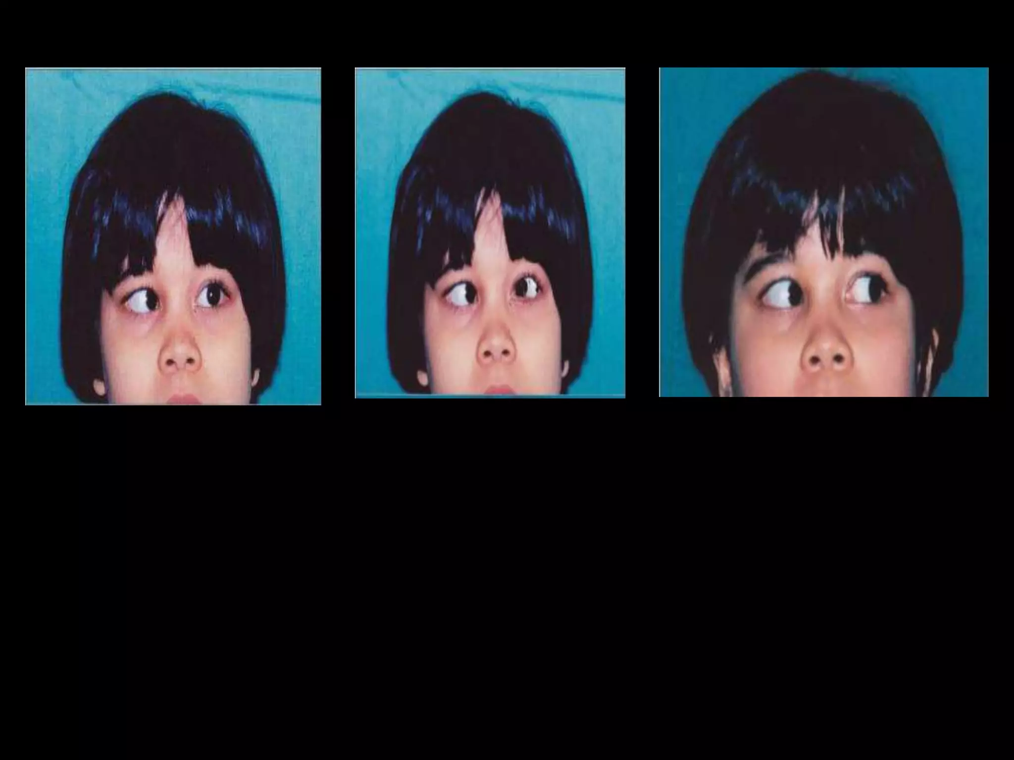 Complications of csom | PPT