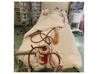 Adult Ecmo