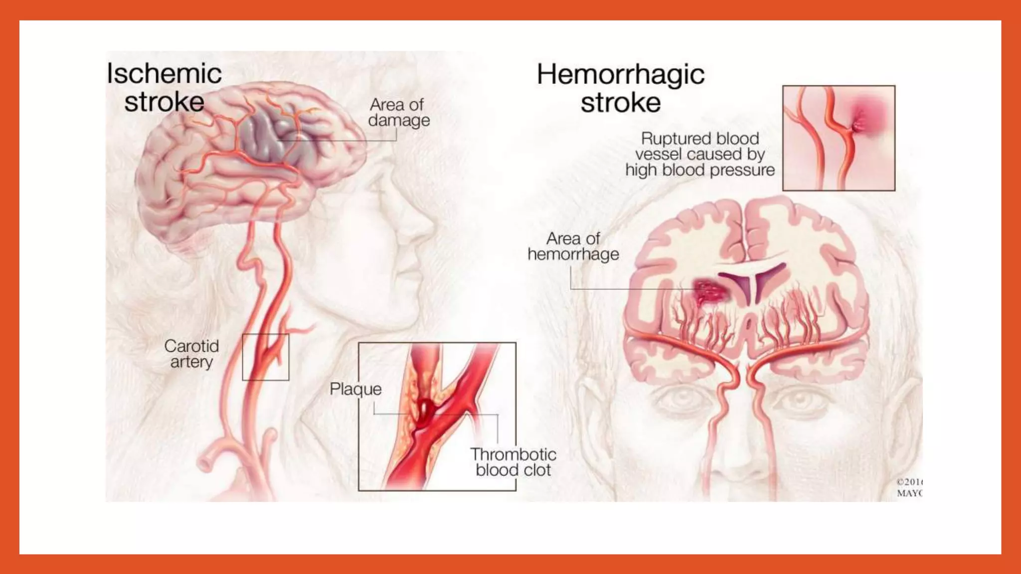 Stroke (Ischemic and Hemorrhagic) | PPTX
