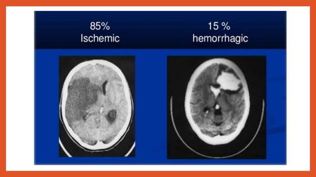 Stroke (Ischemic and Hemorrhagic) | PPTX | Brain and Nervous System ...