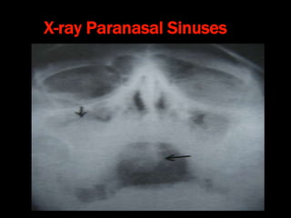 Nasal Polyps X Ray