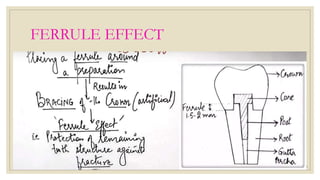 Ferrule effect | PPSX